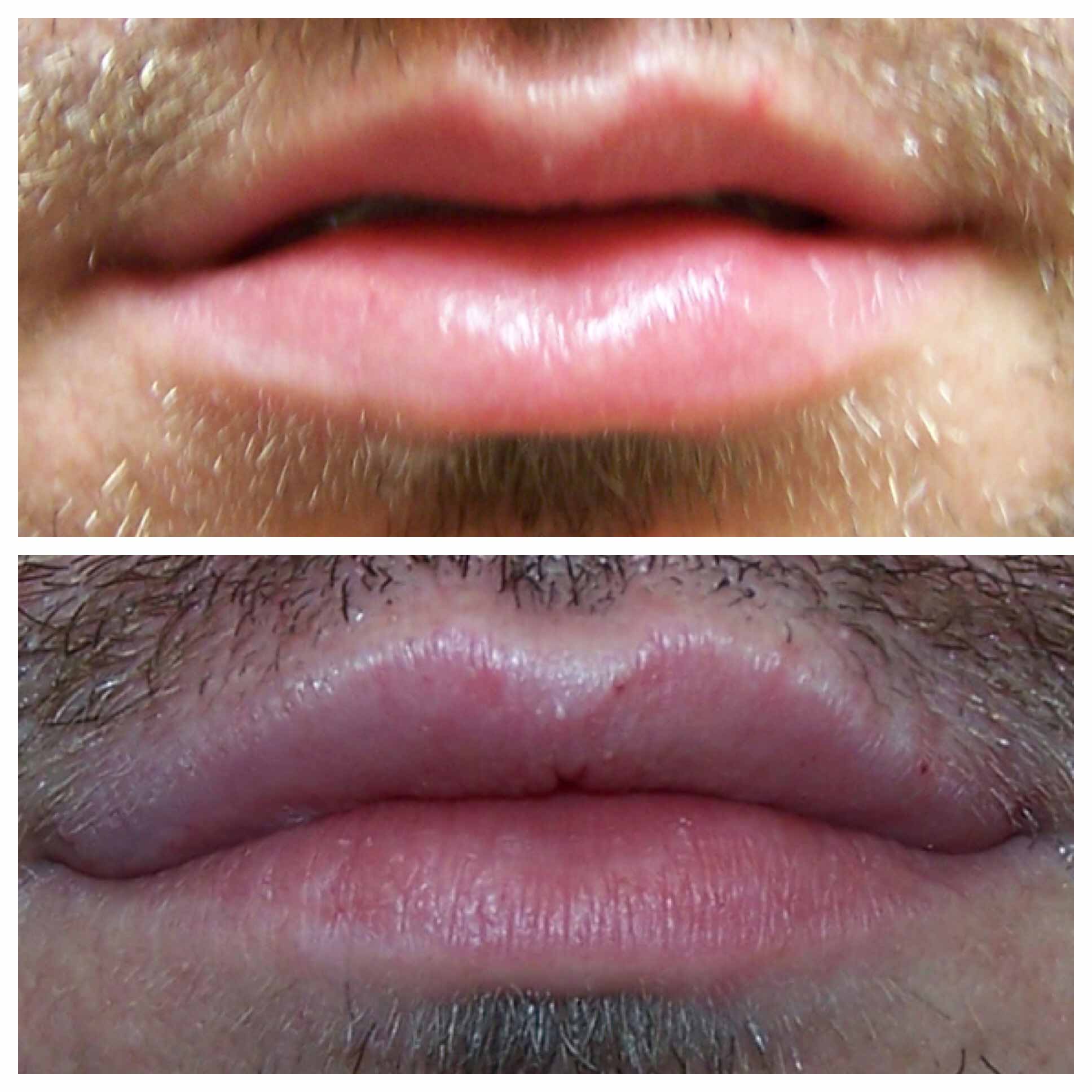restylane-lip-augmentation-men | Radiance Medspa | Avon, Hartford, CT